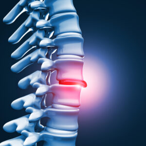 7 Signs Of A Herniated Disc - Spine & Scoliosis Specialists